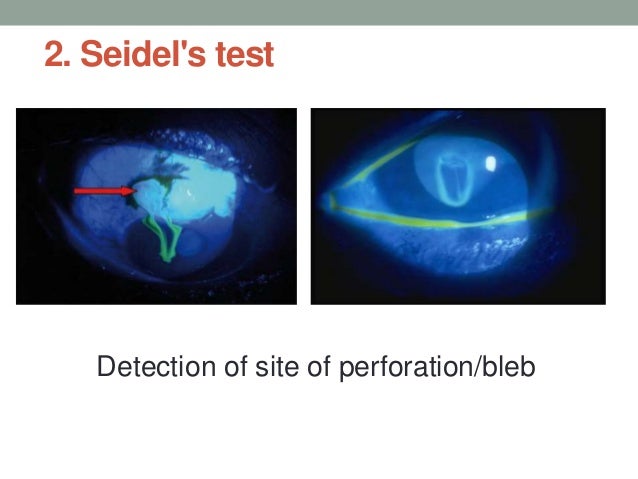 Corneal staining procedure