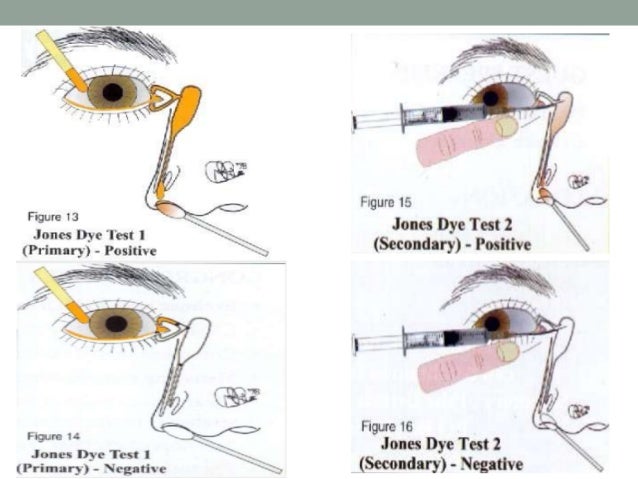 Corneal Staining Procedure corneal-staining-procedure