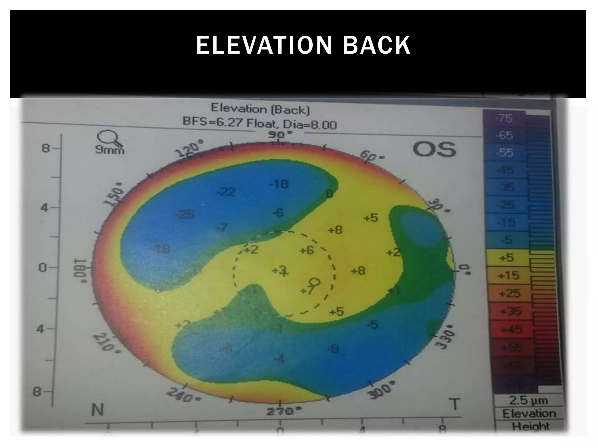 Corneal Topography Corneal Cross Linking Pediatric and Presbyopic ...