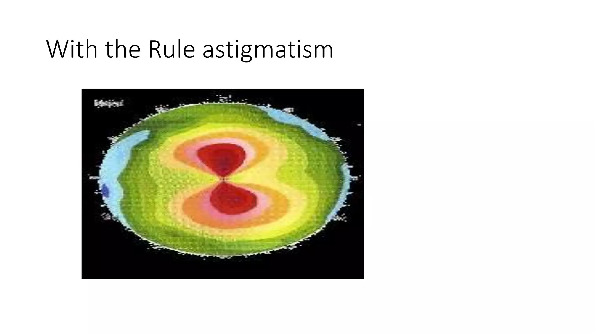 Corneal topographic patterns.pptx