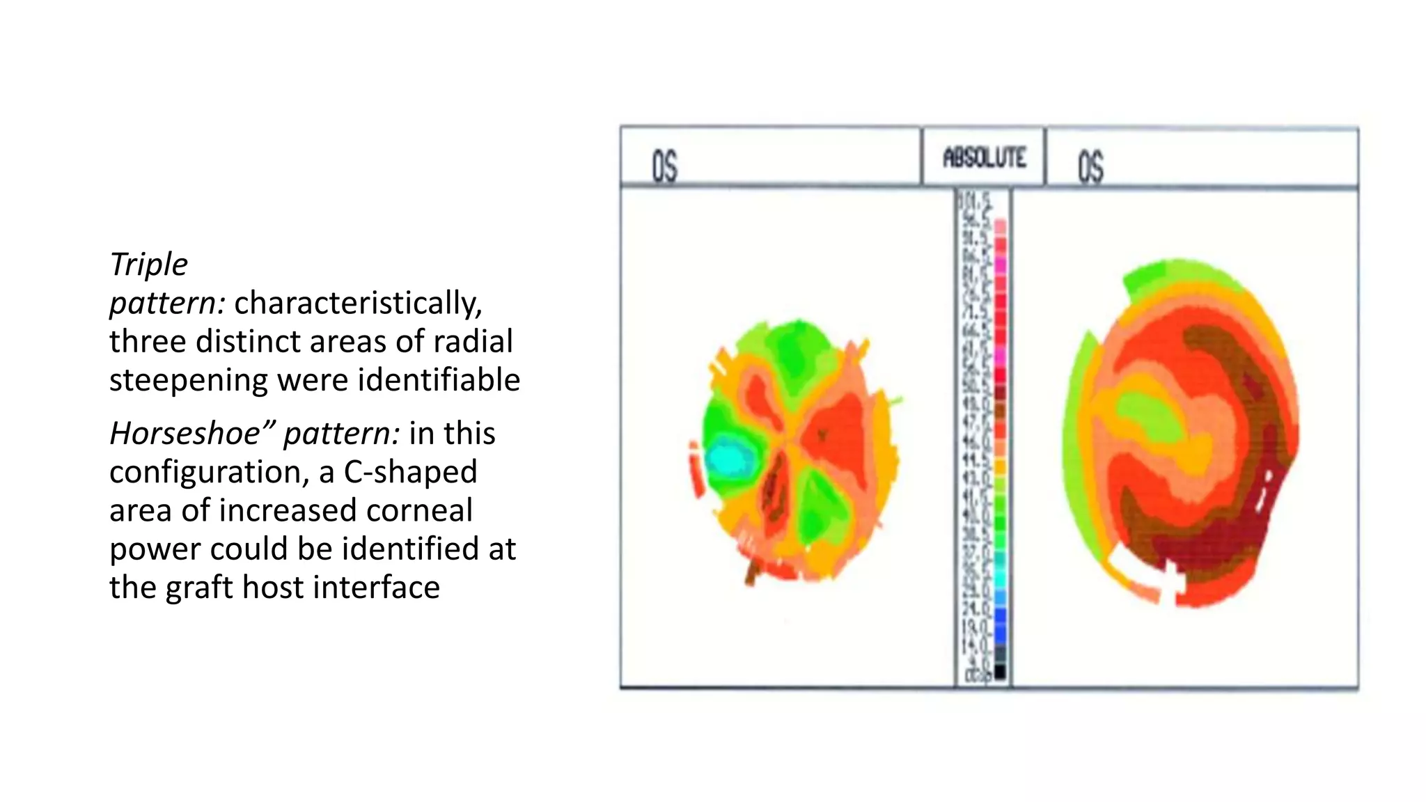 Corneal topographic patterns.pptx