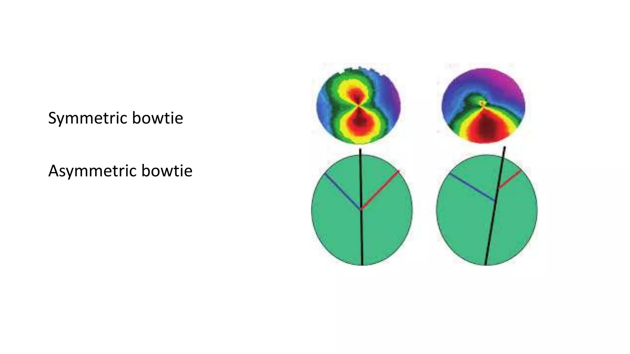 Corneal topographic patterns.pptx