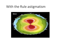 Corneal topographic patterns.pptx