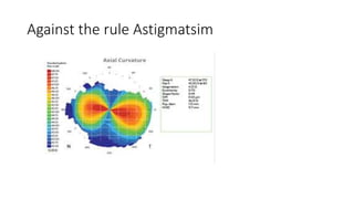 Corneal topographic patterns.pptx