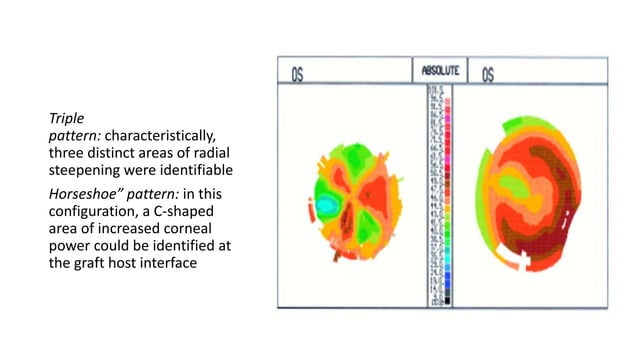 Corneal topographic patterns.pptx