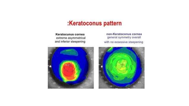 Corneal topographic patterns.pptx