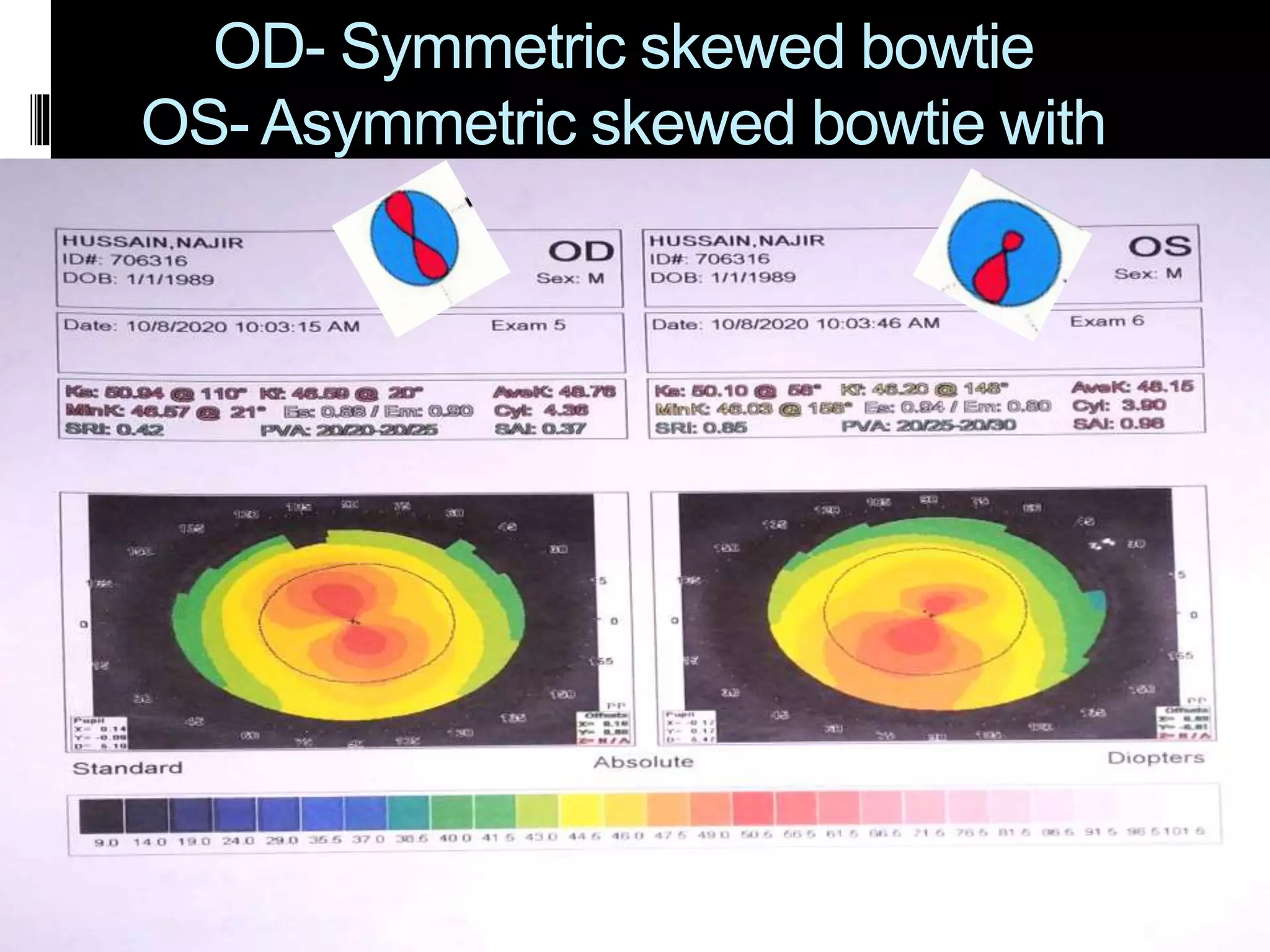 Corneal topographic reports | PPT