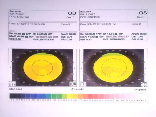 Corneal topographic reports | PPT