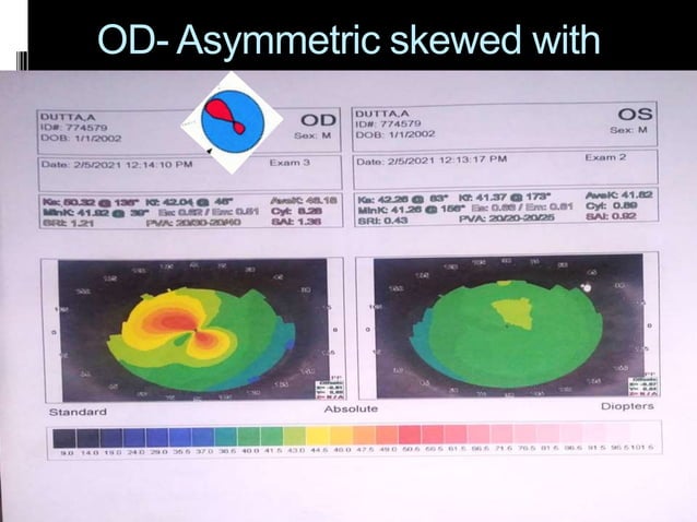Corneal topographic reports | PPT