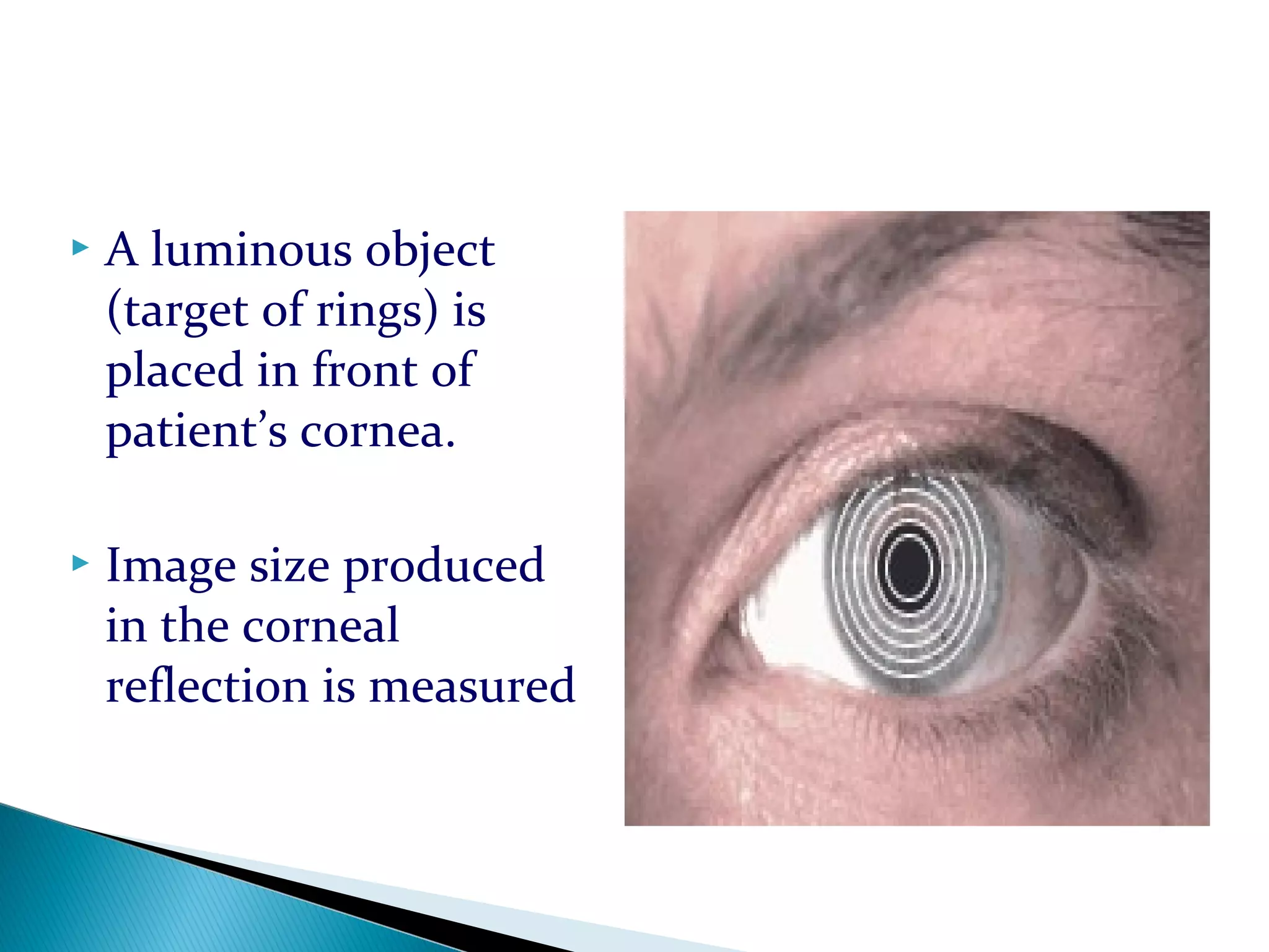 Corneal Topography | PPT