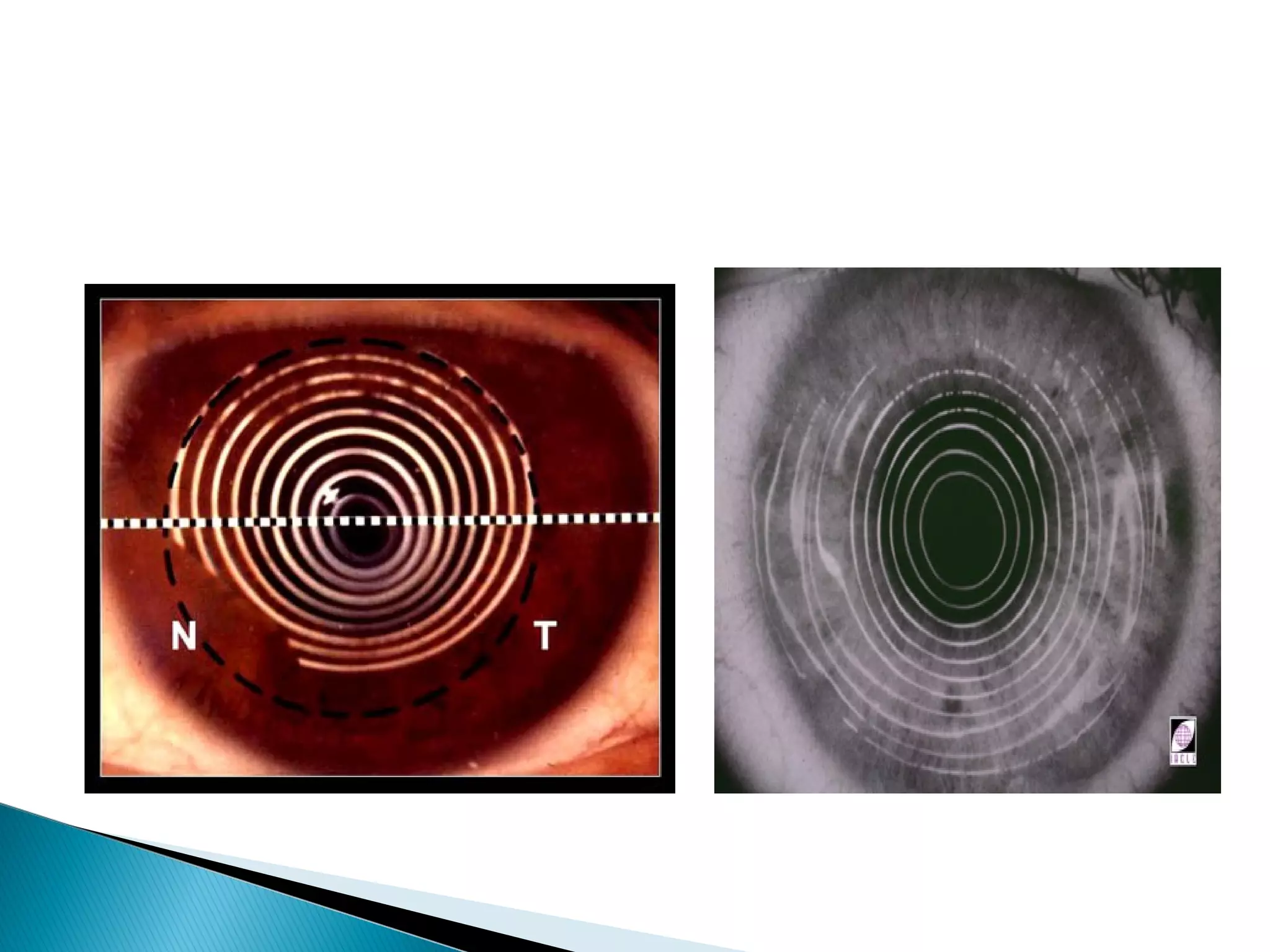 Corneal Topography | PPT
