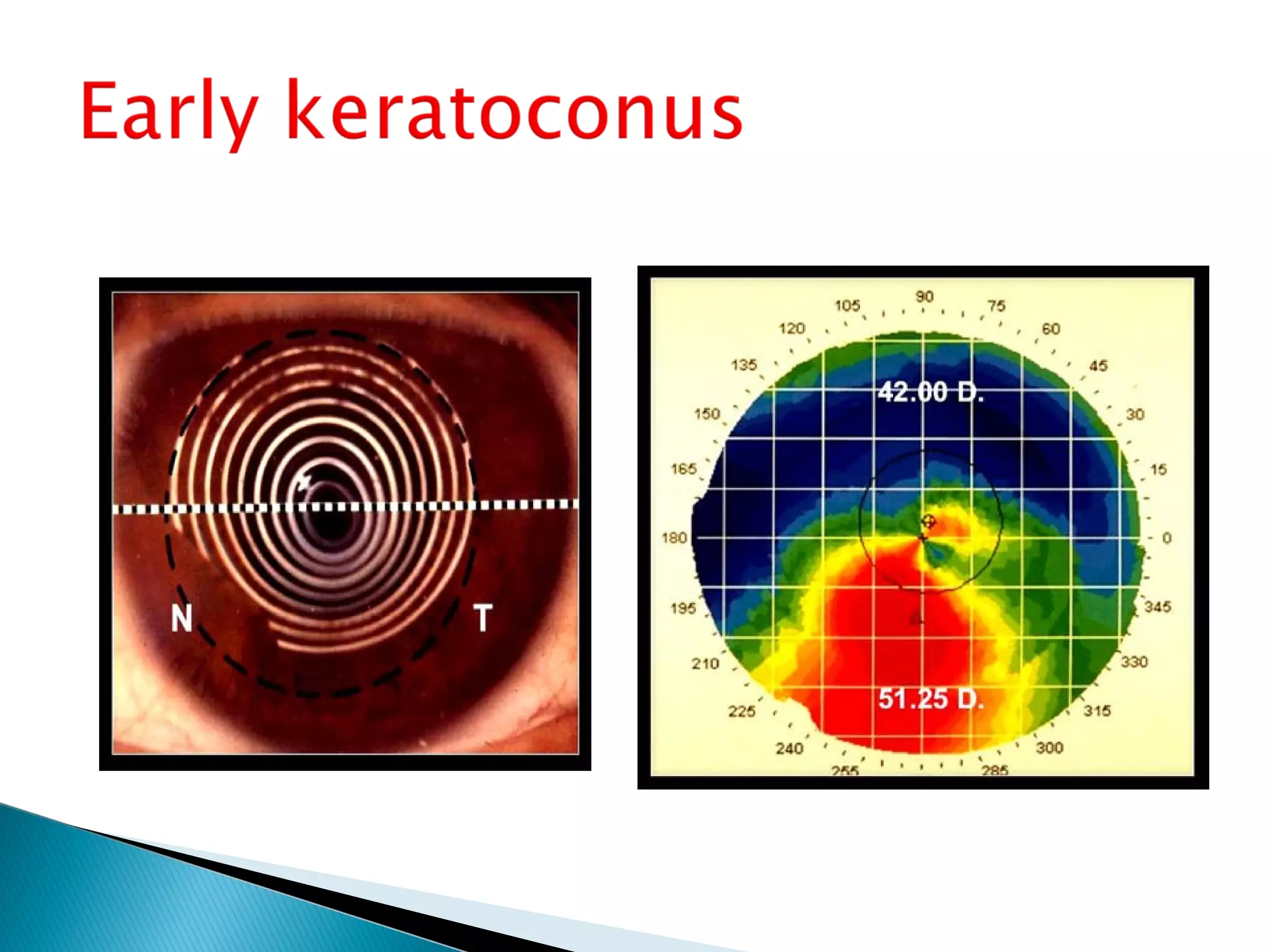 Corneal Topography | PPT