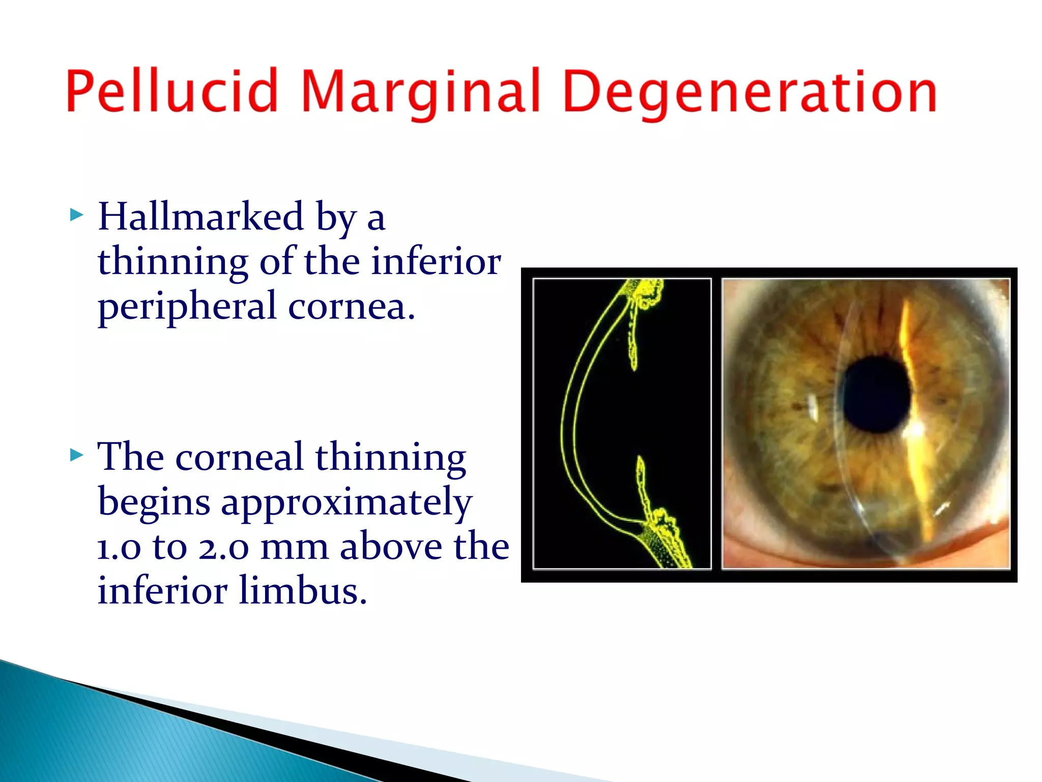 Corneal Topography | PPT