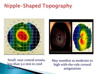 Corneal Topography | PPT
