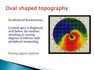 Corneal Topography | PPT