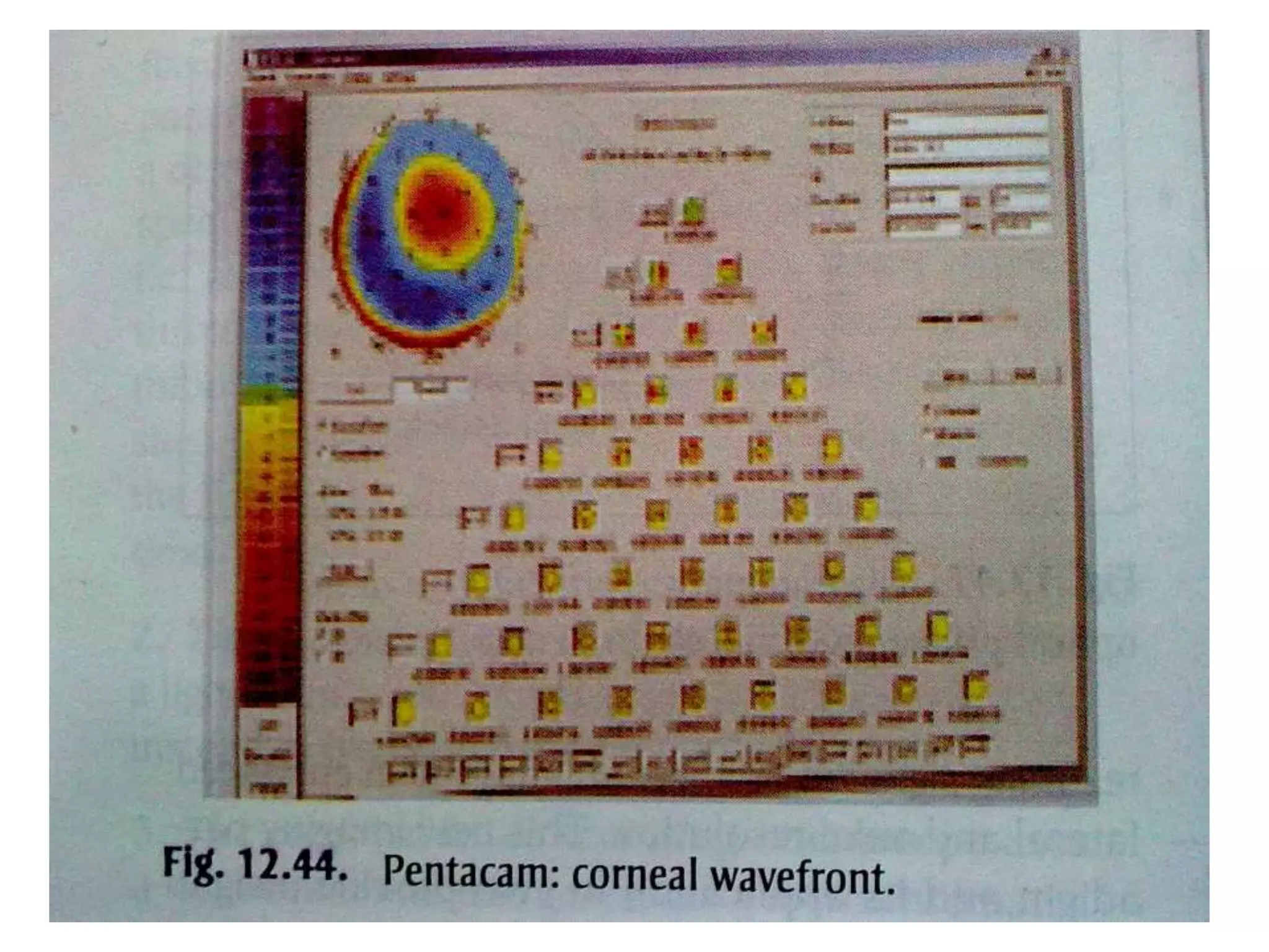 Corneal topography wavefront analysis | PPTX