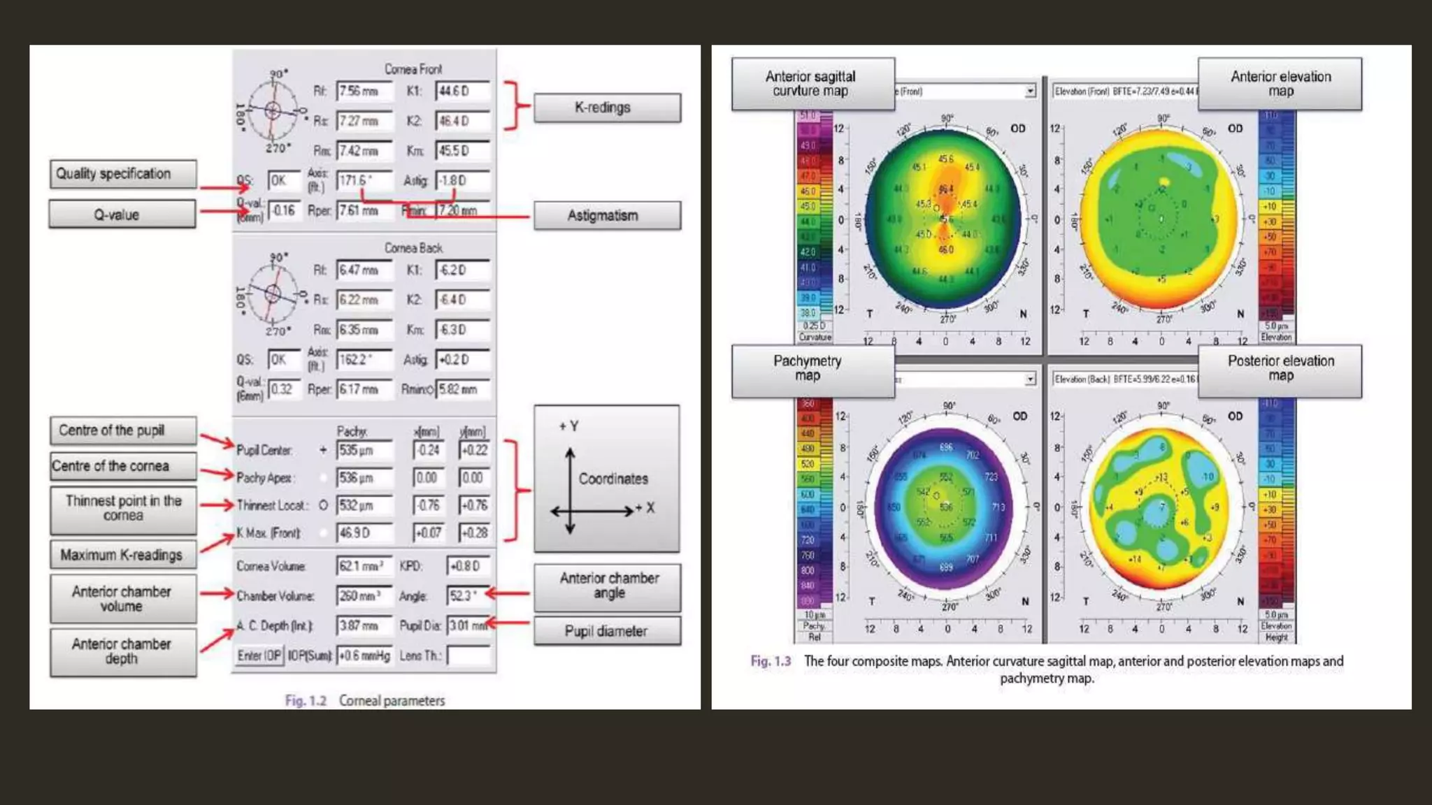 Pentacam and Corneal topography | PPTX