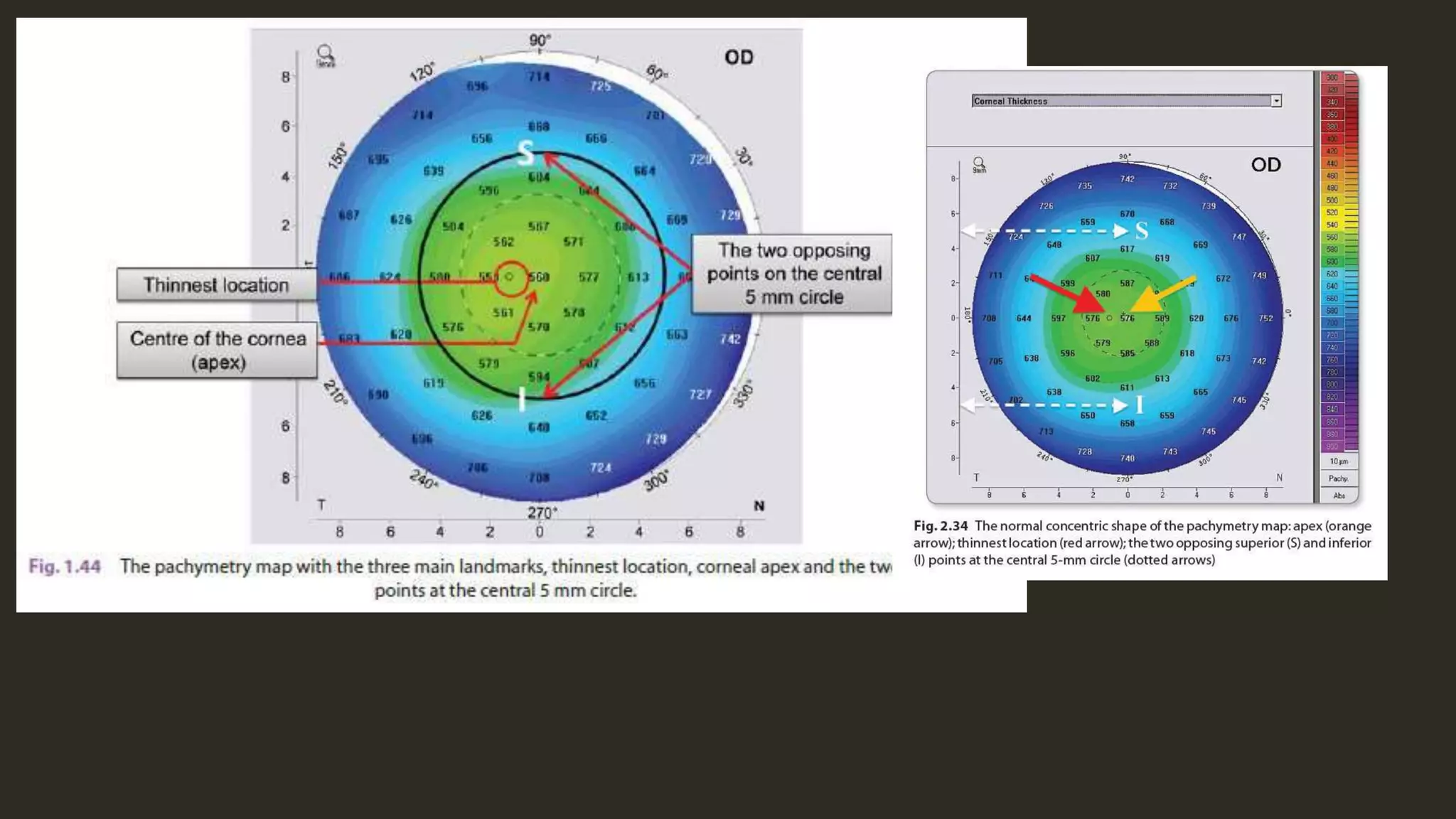Pentacam and Corneal topography | PPTX