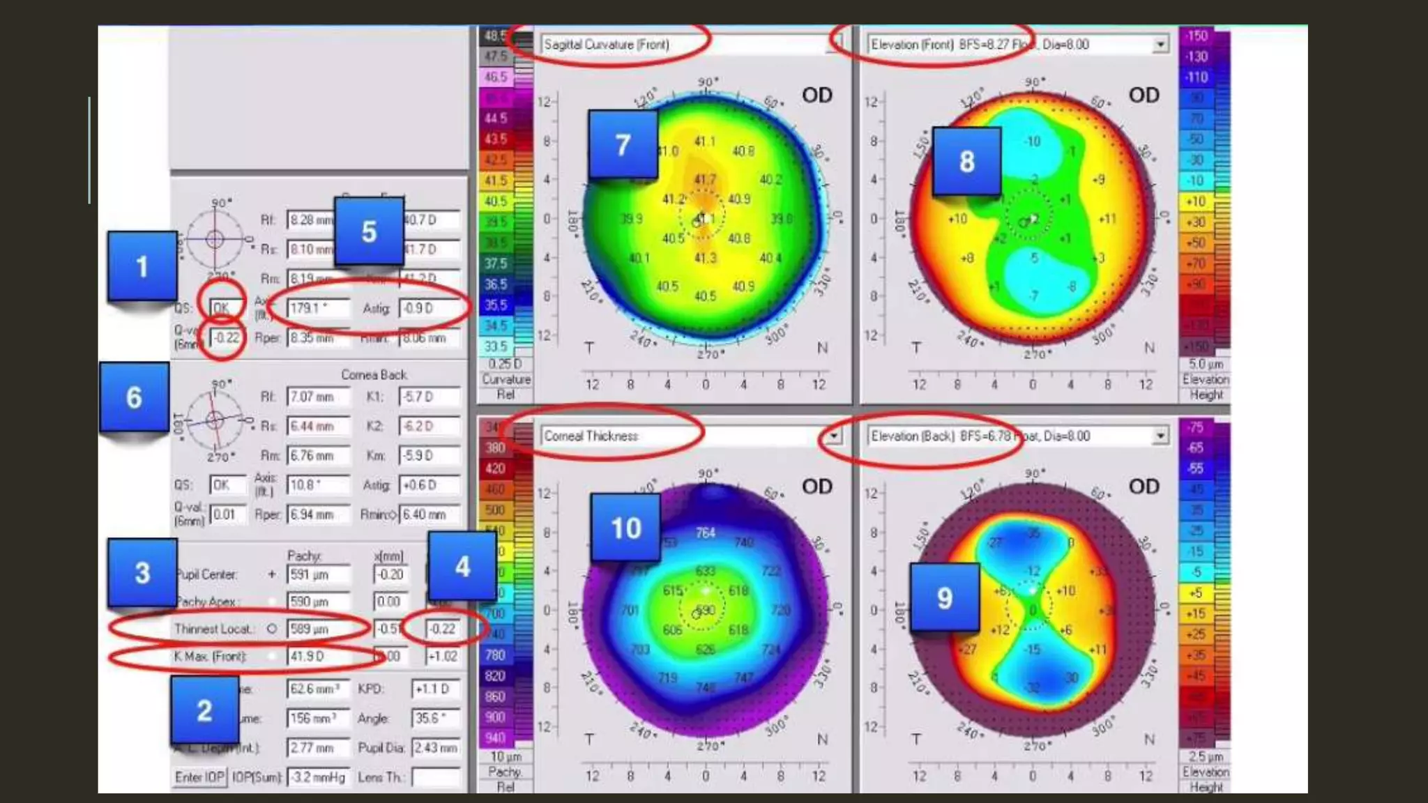 Pentacam and Corneal topography | PPTX