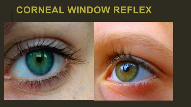 Pentacam and Corneal topography | PPTX | Eye and Vision Conditions ...