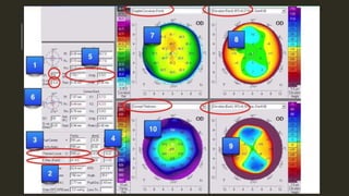 Pentacam and Corneal topography | PPTX