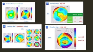 Pentacam and Corneal topography | PPTX