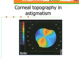 Corneal topography...ppt