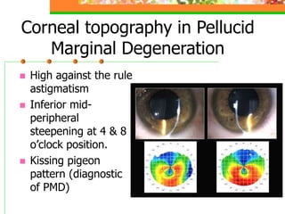 Corneal topography...ppt