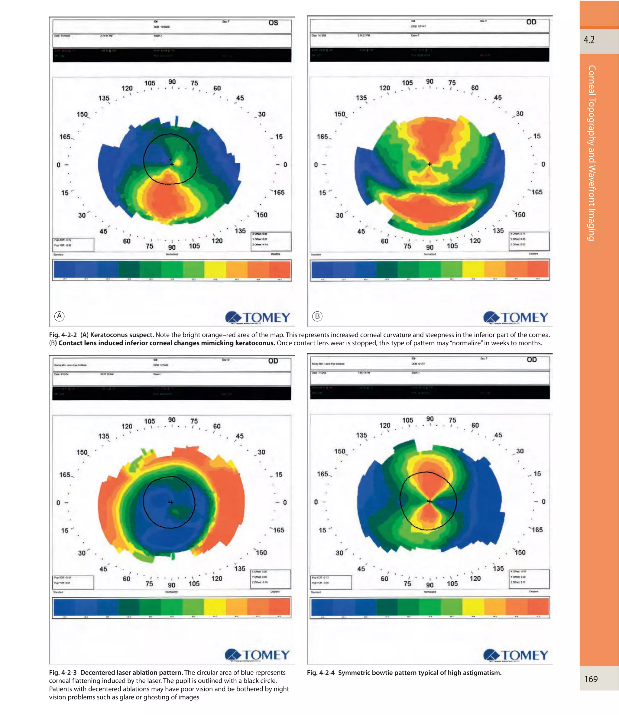 Corneal topography and wavefront imaging | PDF