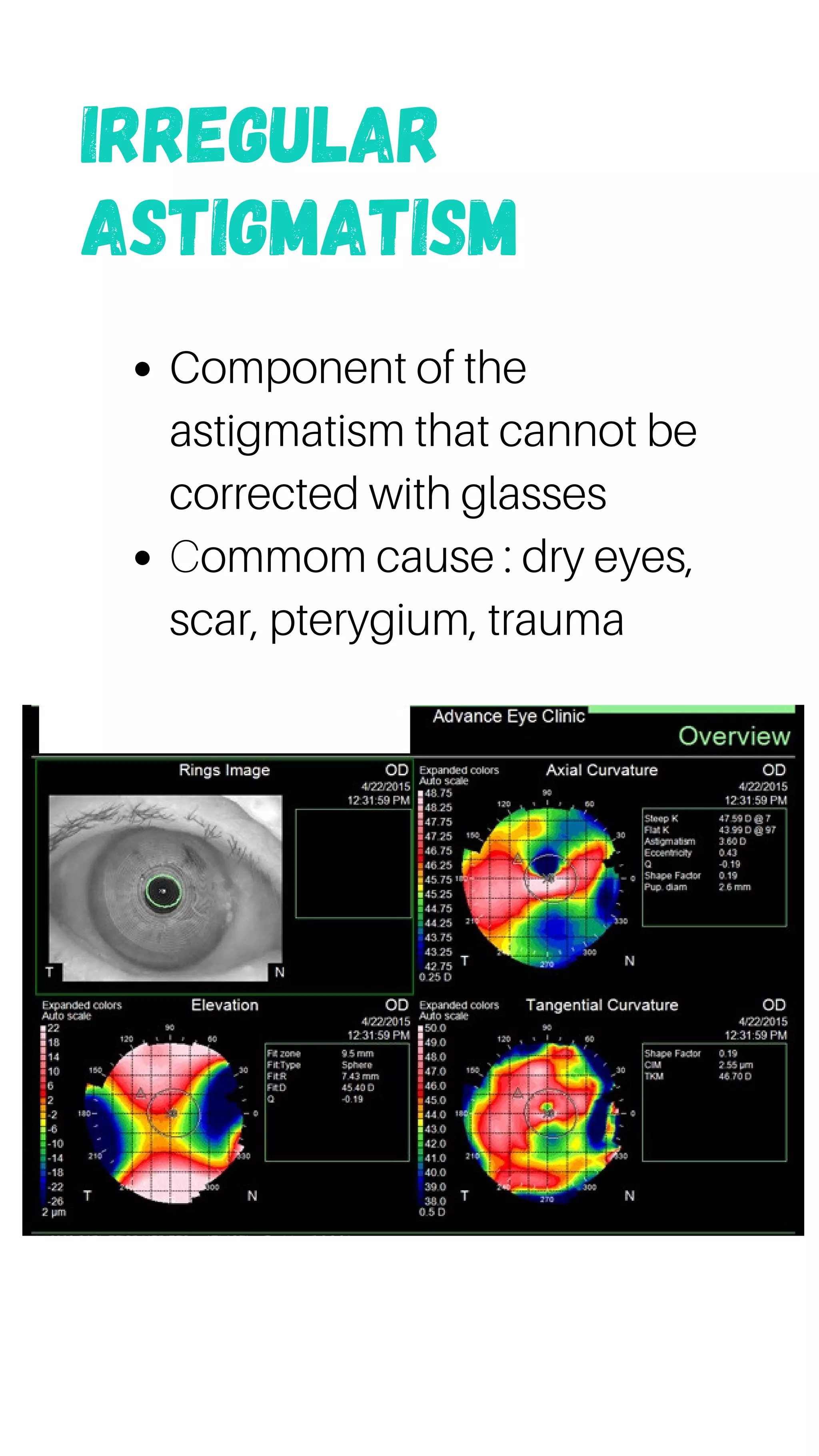 A quick revision on Corneal topography | PDF