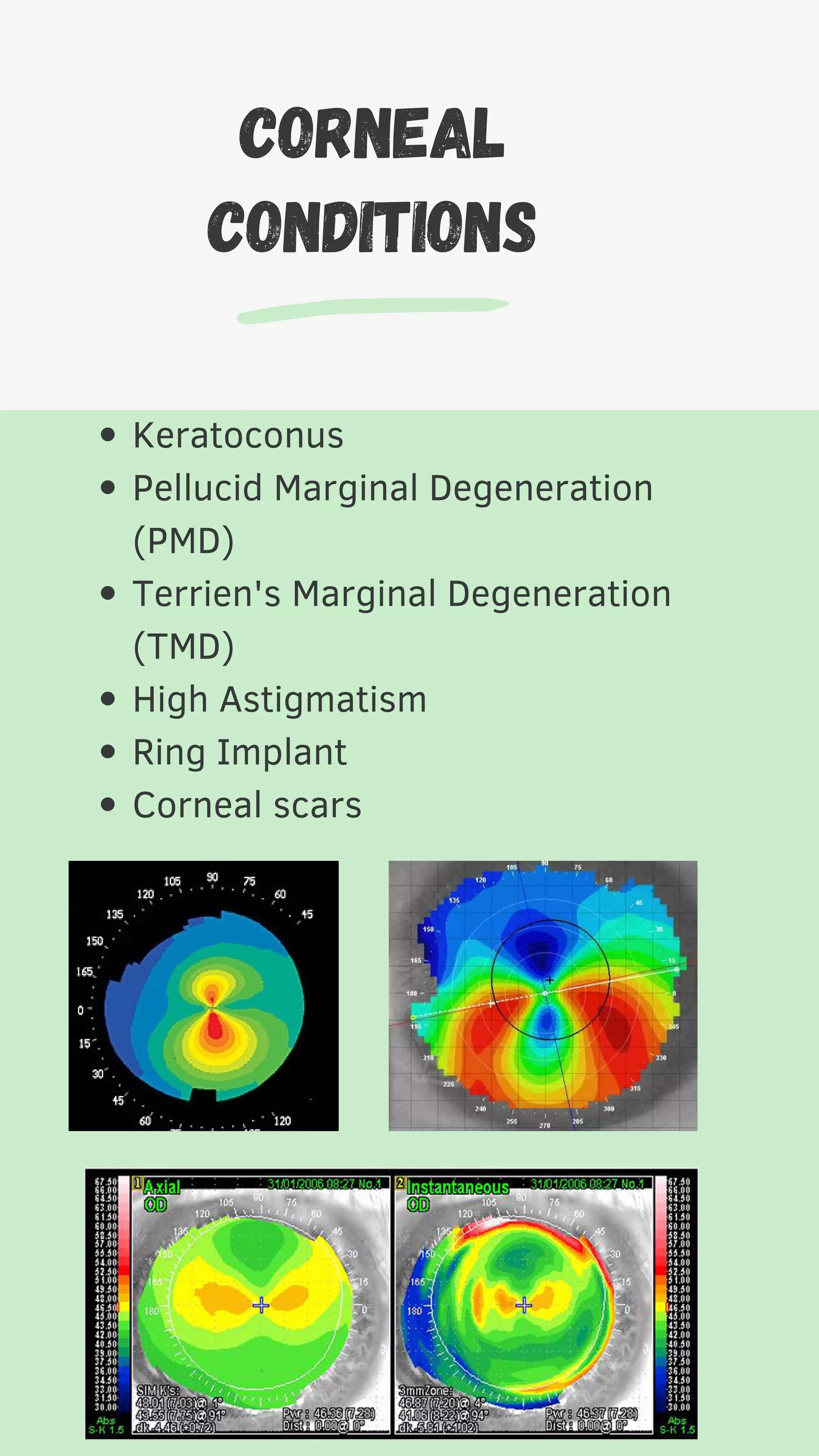 A quick revision on Corneal topography | PDF