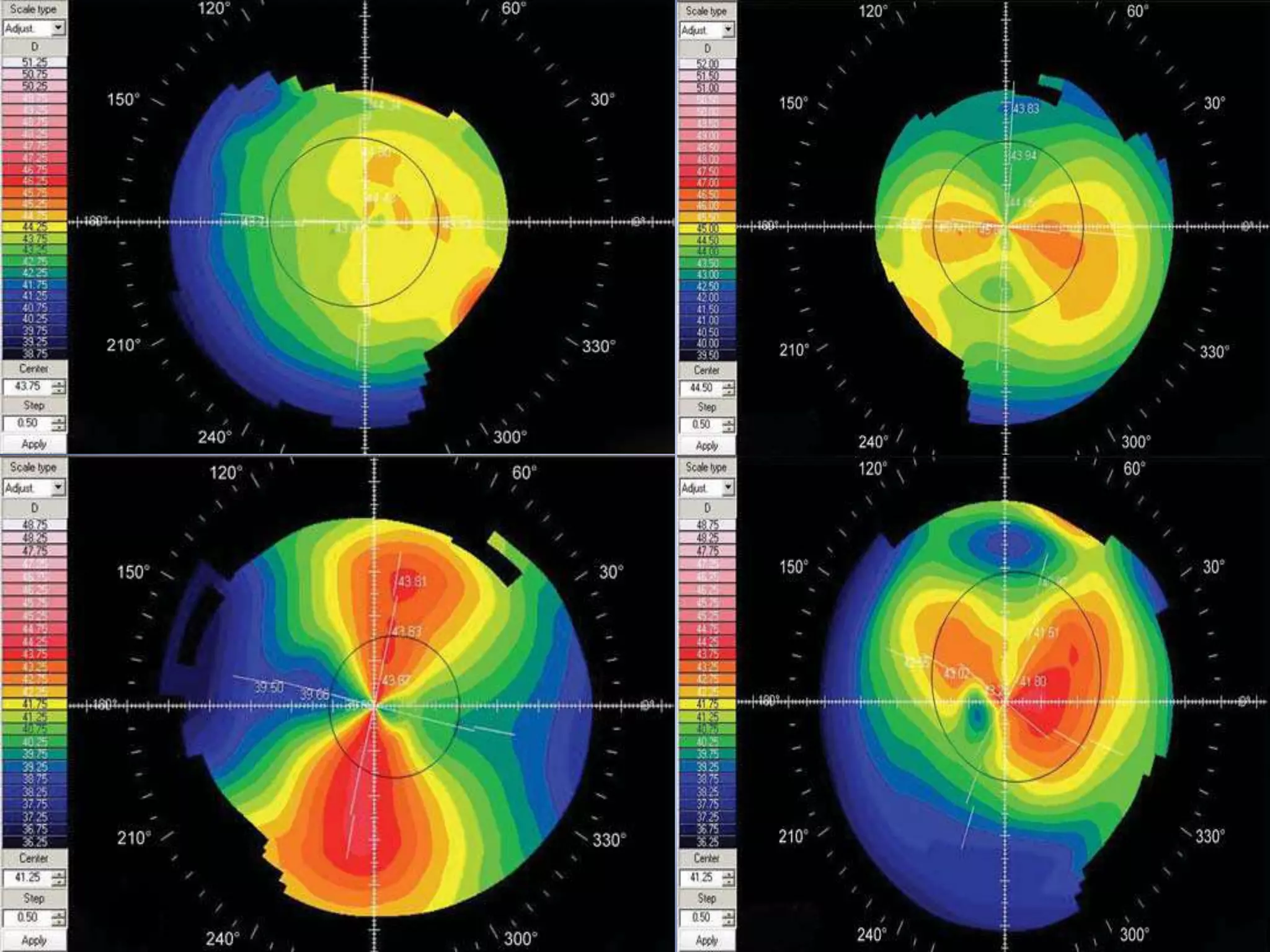 Corneal topography final | PPTX
