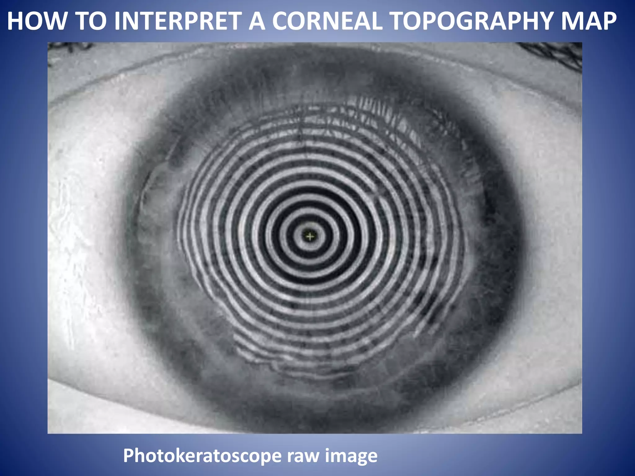 Corneal topography final | PPTX