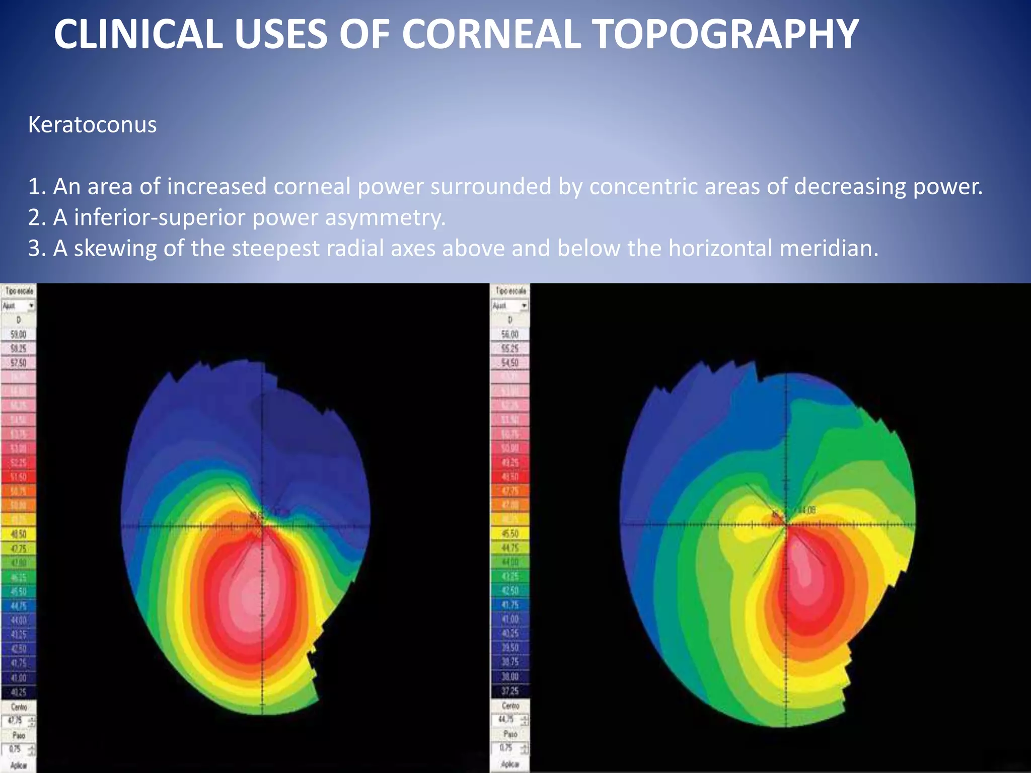 Corneal topography final | PPTX