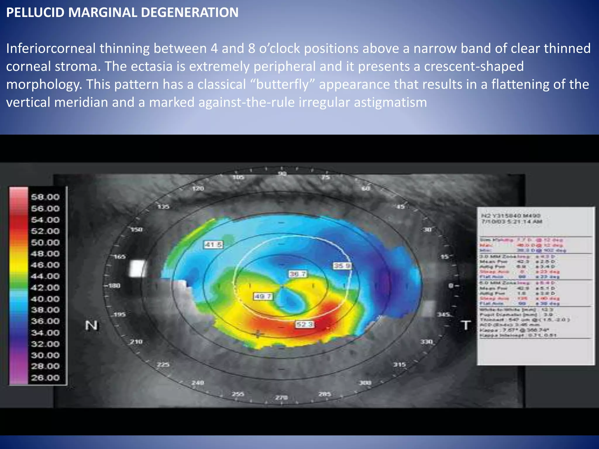 Corneal topography final | PPTX