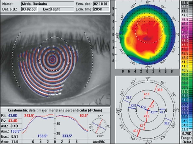 Corneal topography final | PPTX