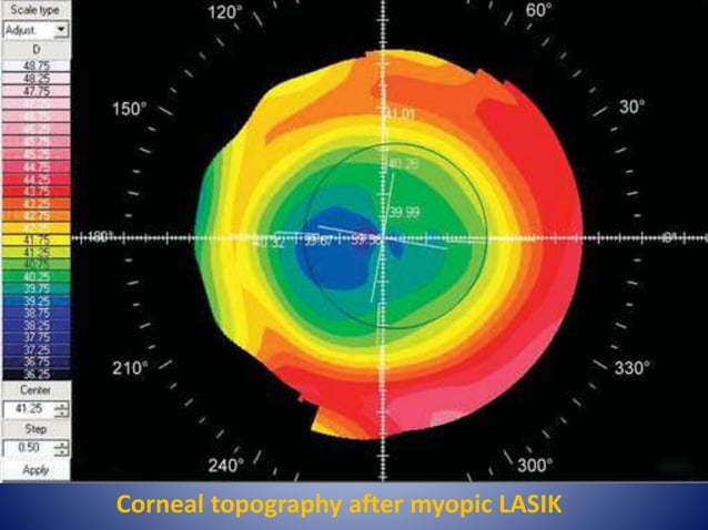 Corneal topography final | PPT