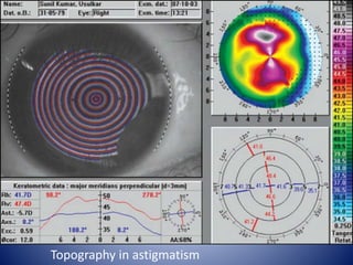 Corneal topography final | PPTX