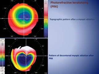 Corneal topography final | PPTX