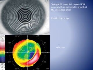 Corneal topography final | PPTX
