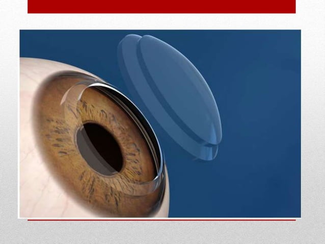 Corneal transparency | PPTX