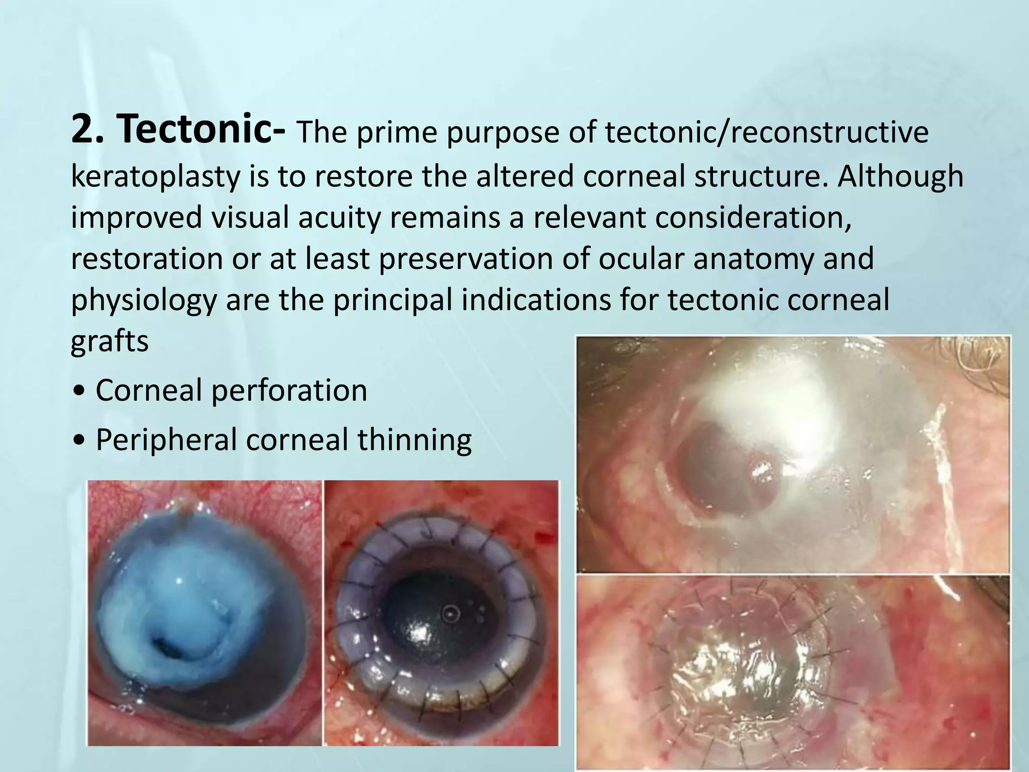 Corneal transplantation | PPTX