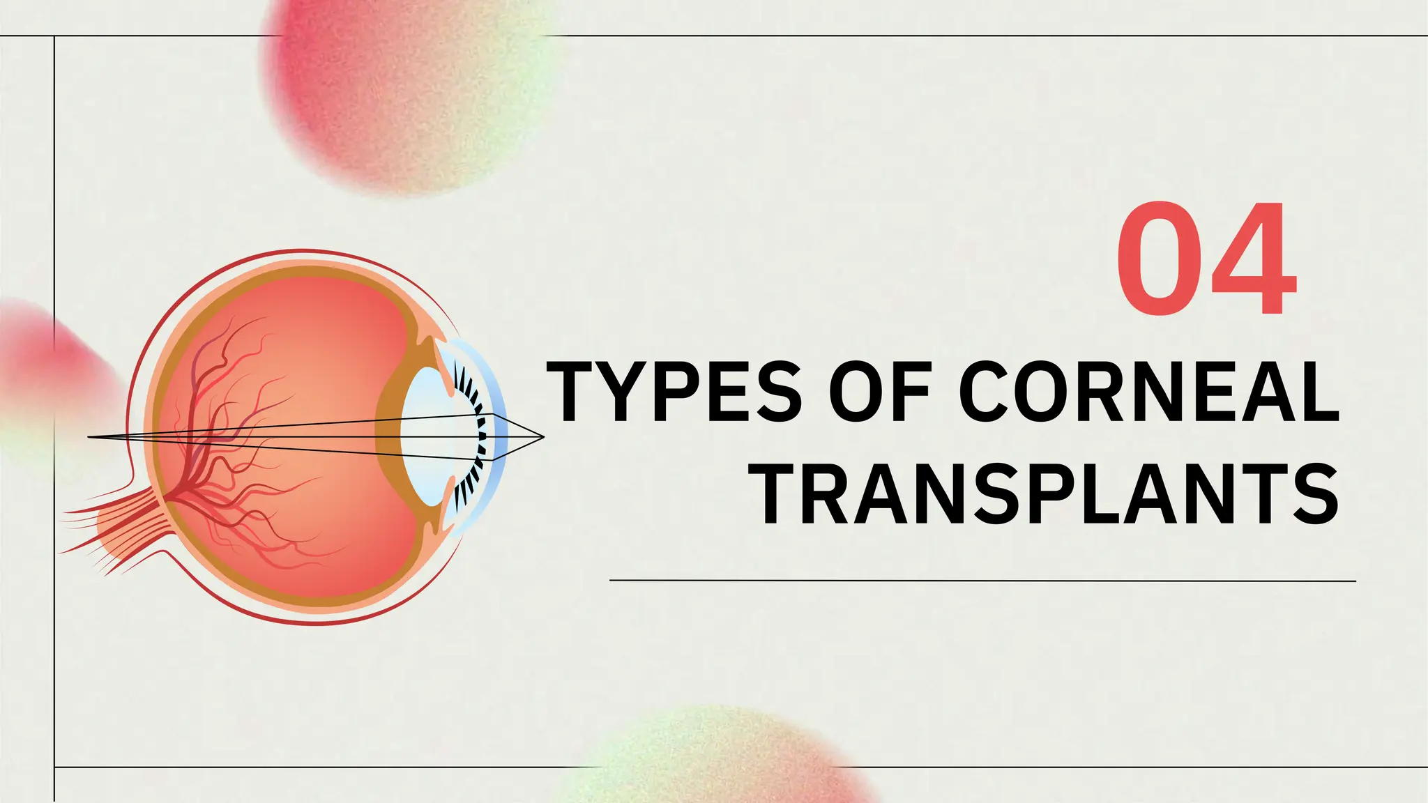 Corneal Transplant Surgery in Mumbai.pptx