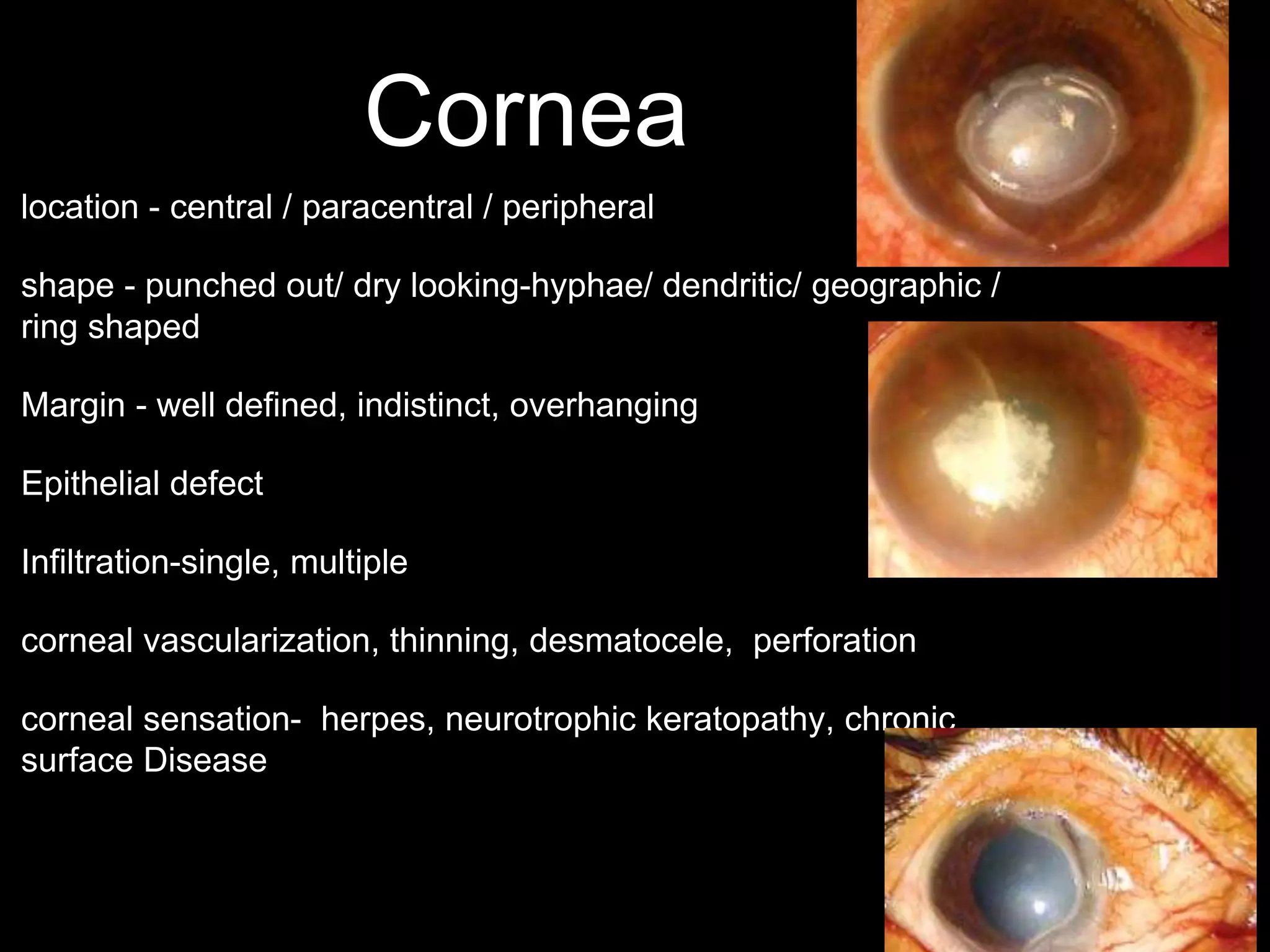 Corneal ulcer | PPTX