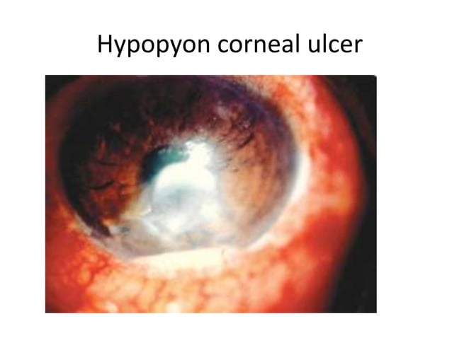 Corneal ulcer | PPTX | Eye and Vision Conditions | Diseases and Conditions