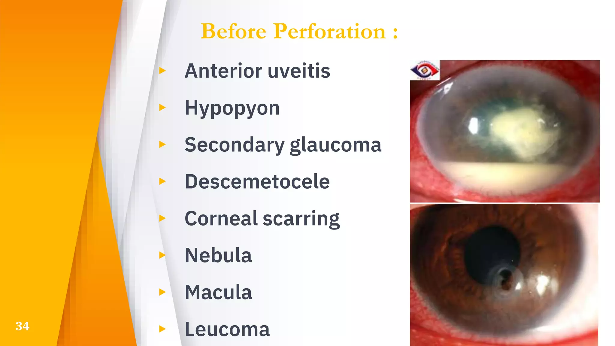 CORNEAL ULCER ,DR M SAQUIB , OPHTHALMOLOGY | PPTX