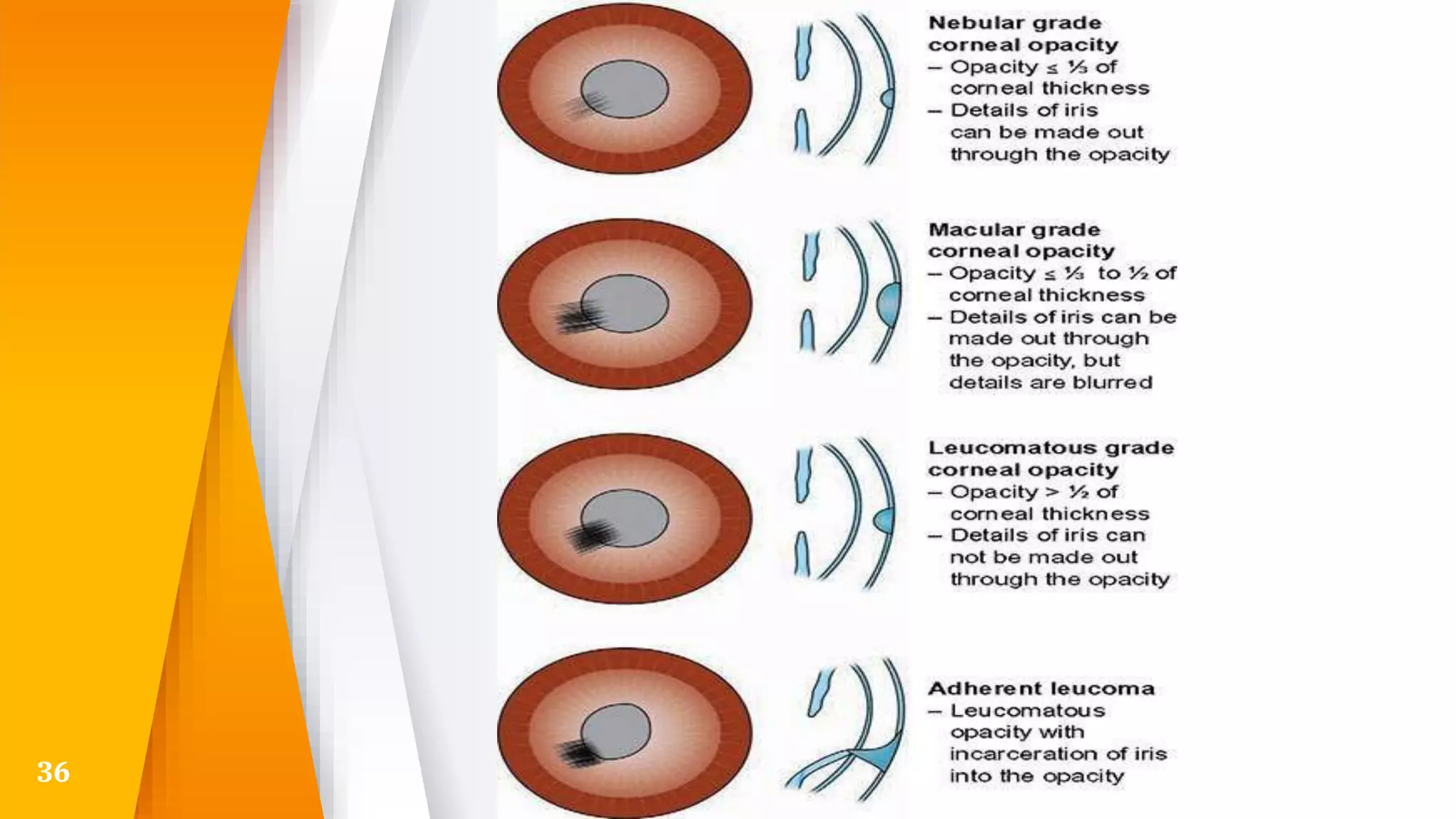 Corneal Ulcer Dr M Saquib Ophthalmology Ppt