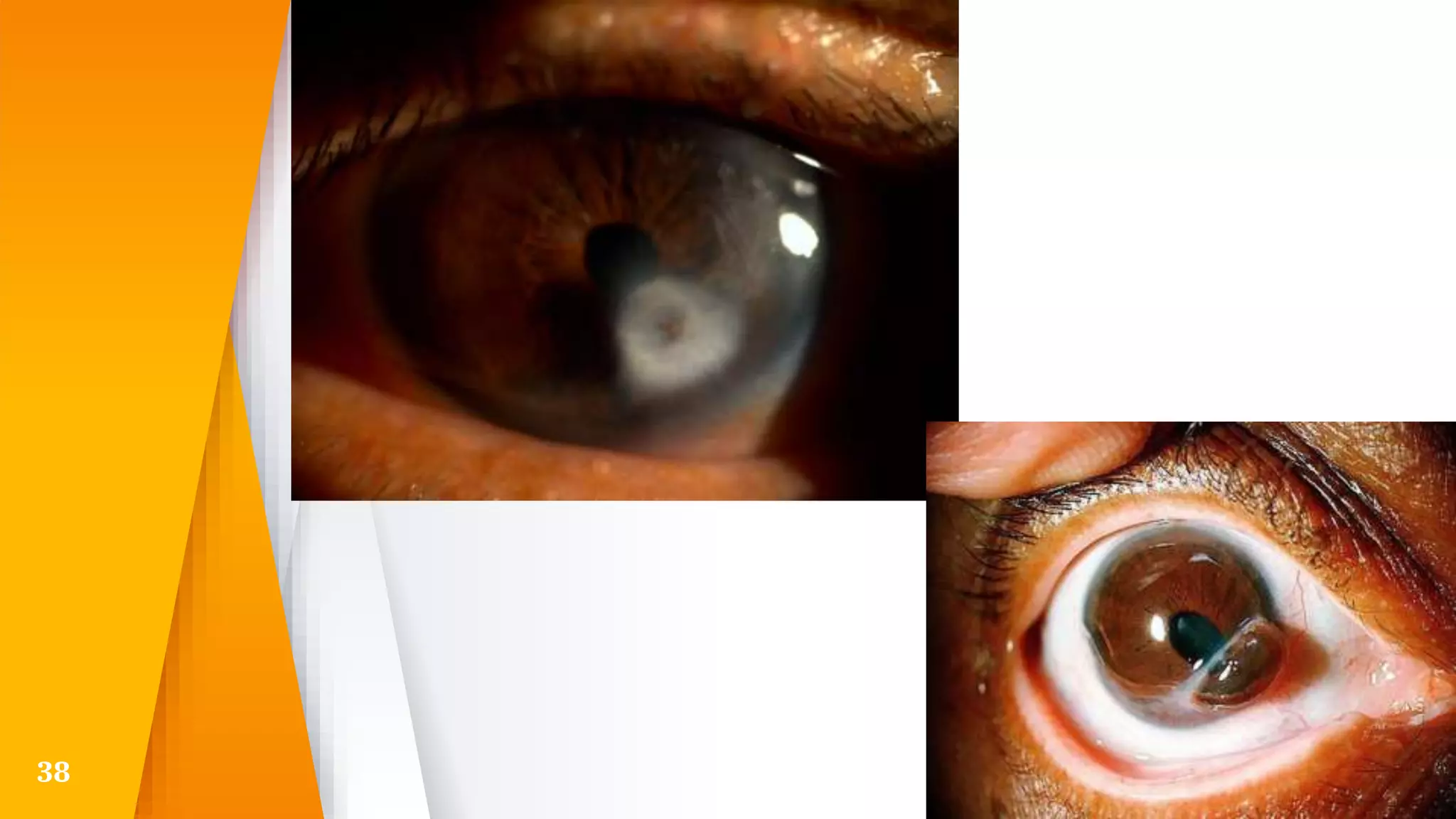 CORNEAL ULCER ,DR M SAQUIB , OPHTHALMOLOGY | PPTX