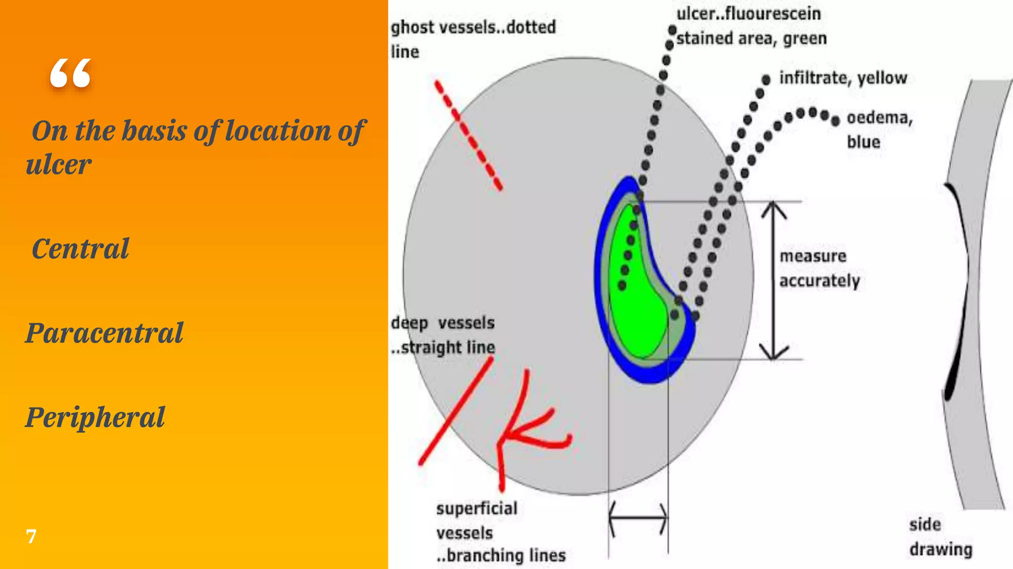 CORNEAL ULCER ,DR M SAQUIB , OPHTHALMOLOGY | PPTX