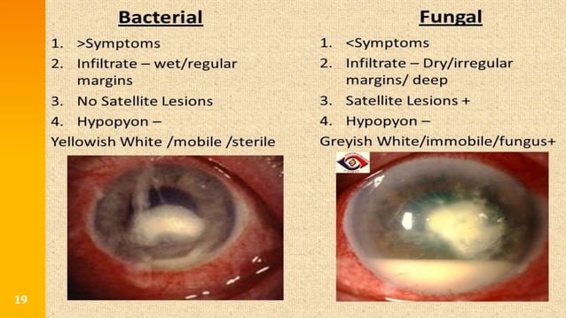 CORNEAL ULCER ,DR M SAQUIB , OPHTHALMOLOGY | PPT